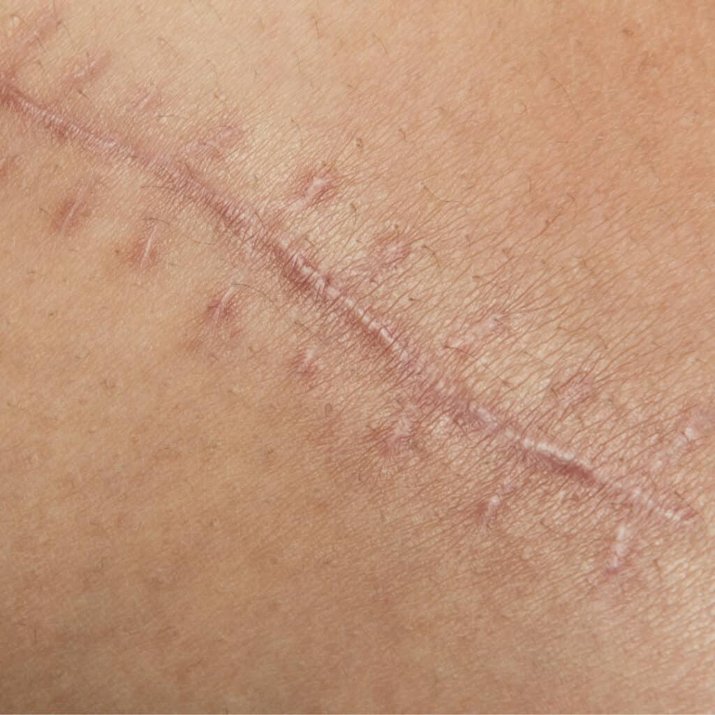 All About Treating Scars - Vie Aesthetics All About Treating Scars - Vie Aesthetics