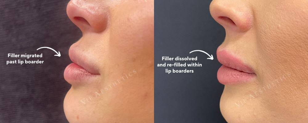 Lip Filler Migration: Causes & Prevention - Vie Aesthetics